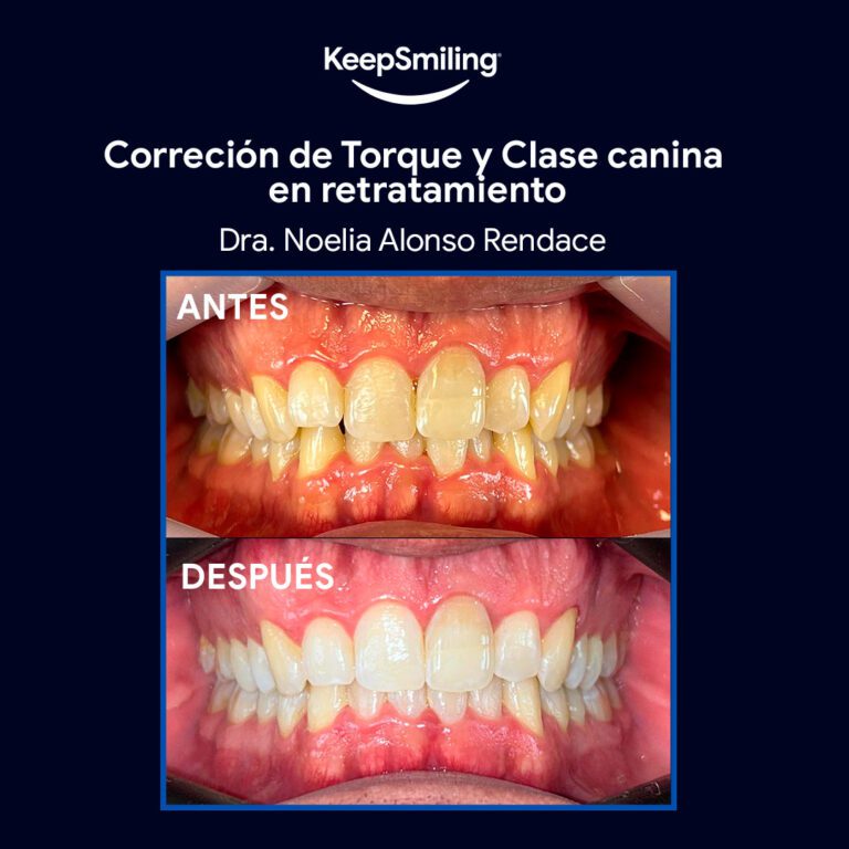 Corrección de torque y Clase canina en retratamiento con Alineadores ...